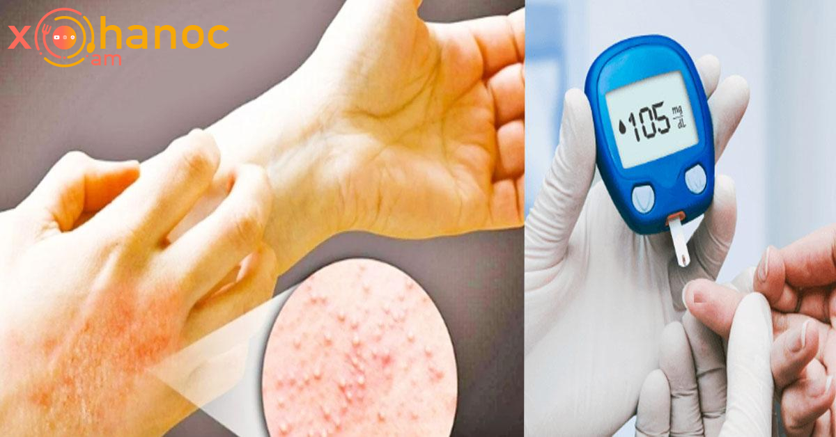 Xohanoc.am Media” Limited Liability Company (LLC): Սա շաքարային դիաբետի ...